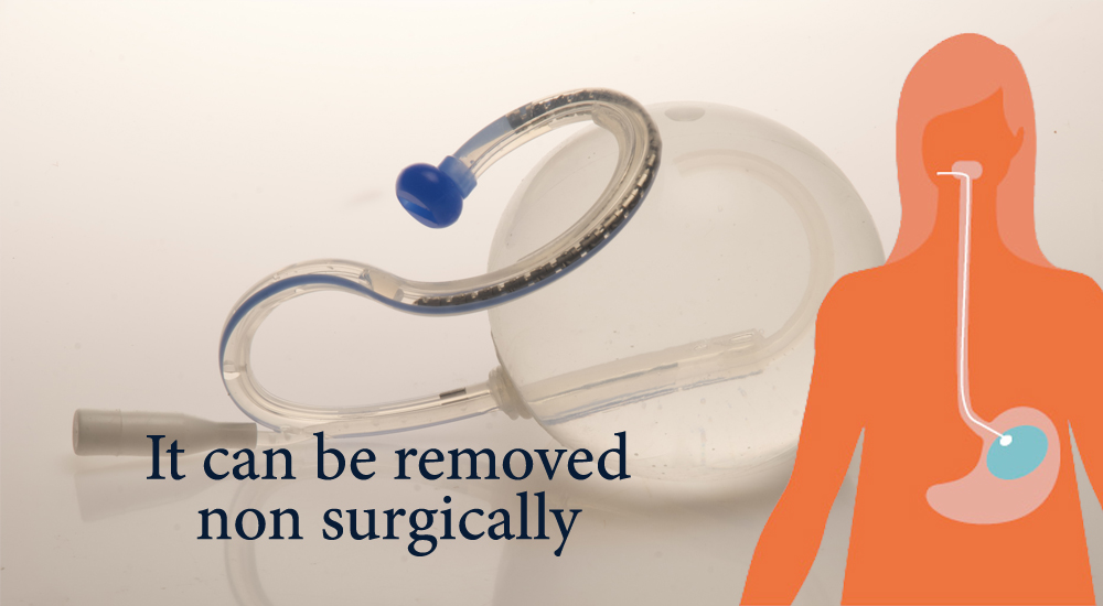 What are the Advantages of ORBERA Intragastric Balloon System?
