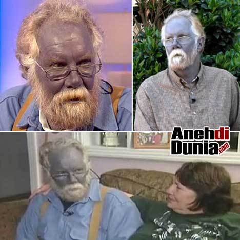 Manusia Dengan Kulit Paling Aneh Di Dunia - Wah Fakta