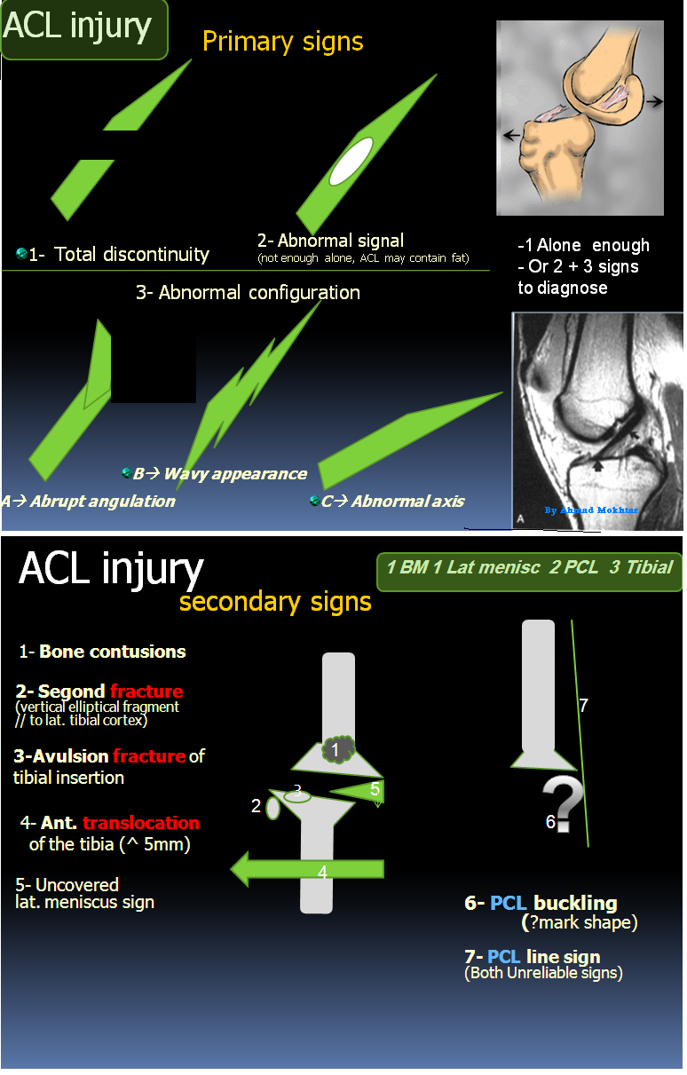 STUDENTS OF PROF.MAMDOUH MAHFOUZ: ACL injury Signs