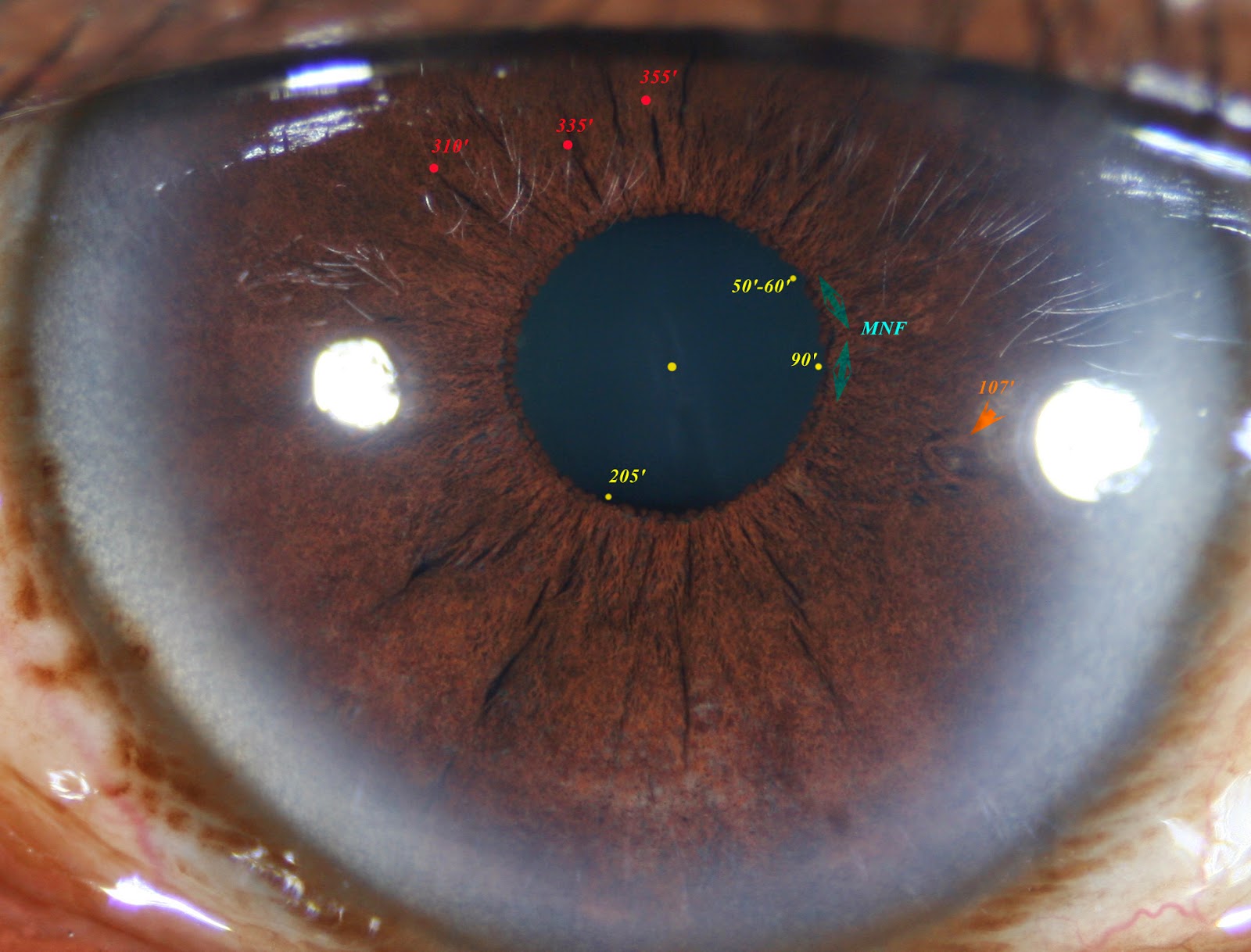 Modern & Multidimensional Iridology: Local Absent of the IPB, Pupil ...