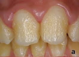 3 Powerful Tips To Help You Repair Tooth Enamel