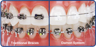 Ortodoncia Damon System. Uruguay, Argentina: El Sistema Damon
