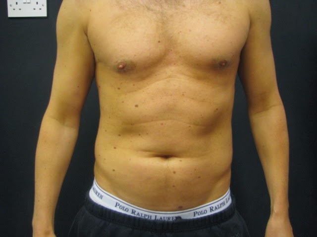 Selston Cosmetic Clinic: Vaser Lipo Male Abs - Nottingham, Derby ...