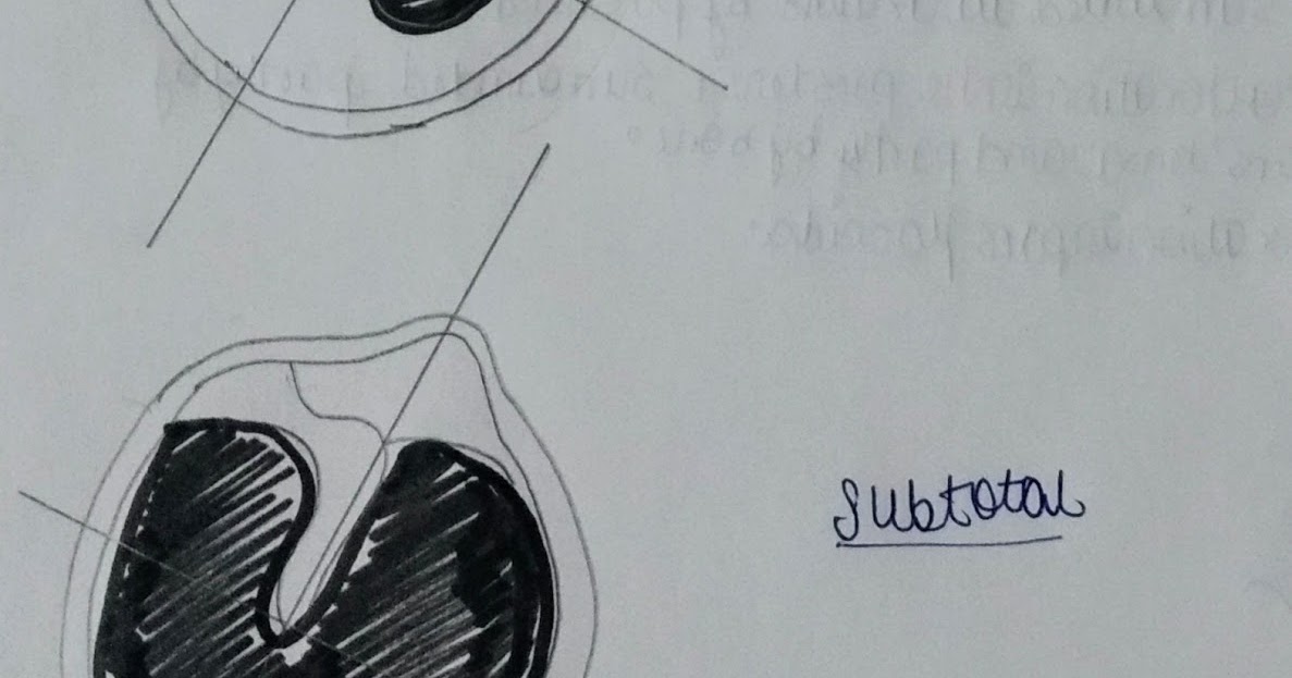 Medicowesome: Types of tympanic membrane perforation