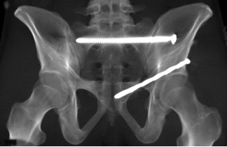 Case of the Month: Fracture cases at Harborview Medical Center ...