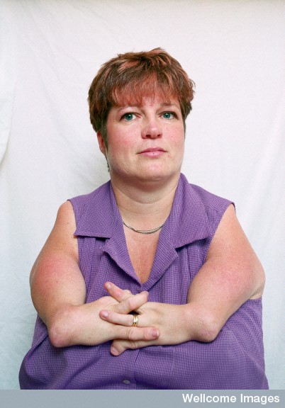 Thalidomide 50 Years On | Wellcome Library