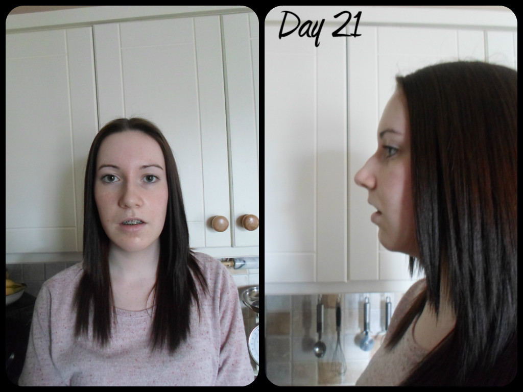 My Jaw Surgery And I Day 21 Three Weeks Another Video my-jaw-surgery-and-i-day-21-three-weeks-another-video