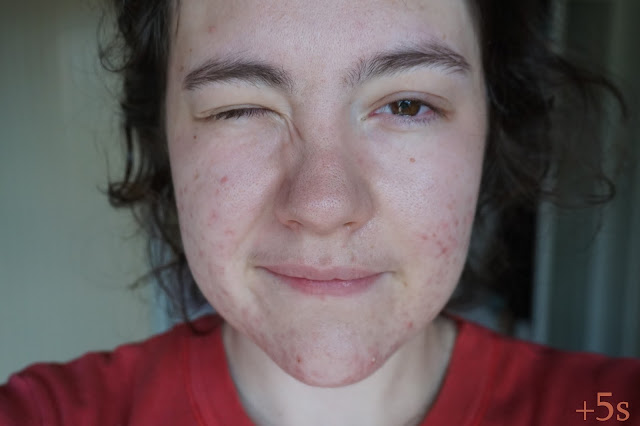 At War with Acne: Cicalfate & TriAcnéal Expert (Avène) won ! - Flavour ...