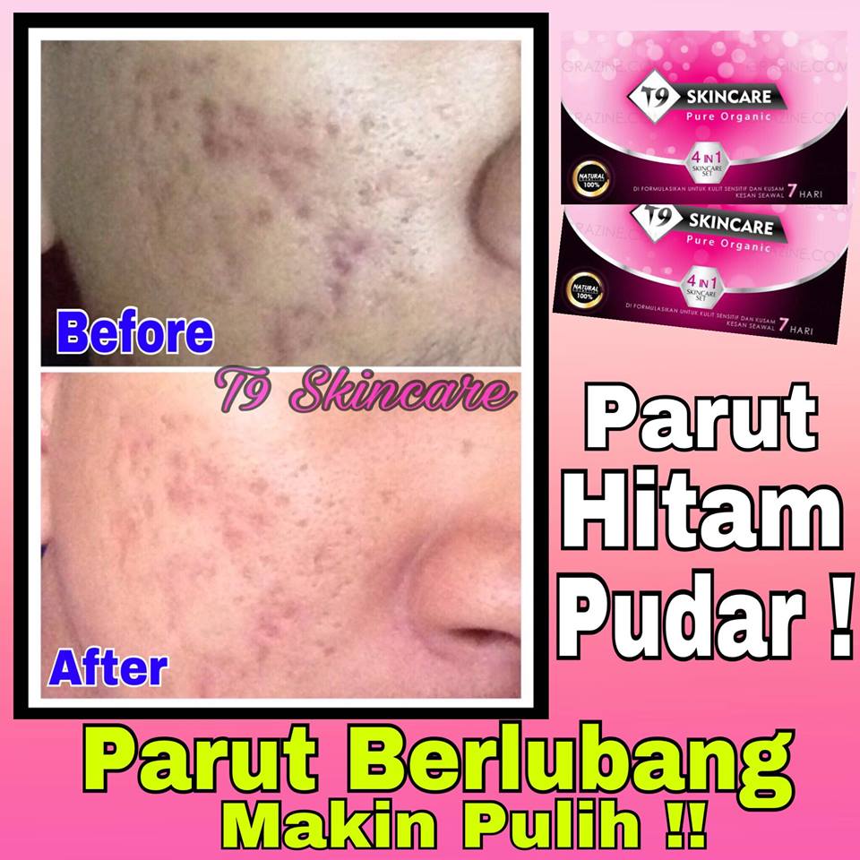 T9 SKINCARE: SERUM HILANG PARUT BERLUBANG & PARUT HITAM DENGAN BERKESAN