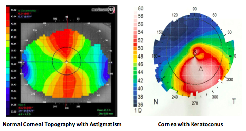 Is Your Nearsightedness Really Just Increasing? Or It Is Keratoconus?