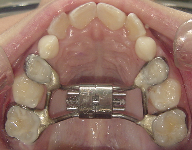 Carol's Lab: Disjuntor tipo HYRAX