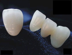 Crown and Bridges ~ Gigi Sehat