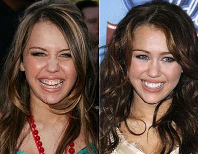 Miley Cyrus Dental Treatment