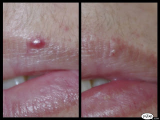 Clínica Hernández Vicedo, Alcoy: FOTOESCLEROSIS CON LÁSER Nd-Yag