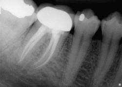 Bauman Endodontics: More examples of failing root canals because of ...