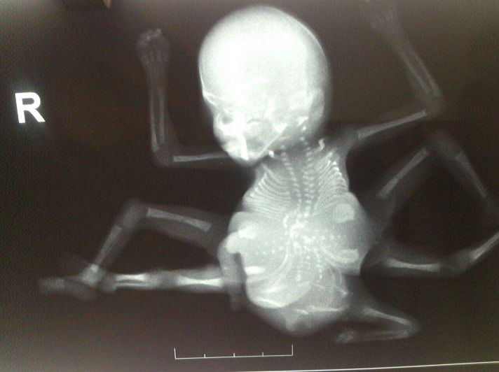 Dr Rajshree Katke (Nee Sonkawde): A rare presentation of heteropagus ...