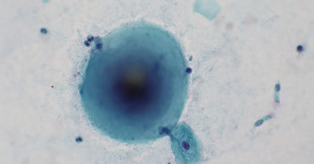 Corpora Amylacea Prostate, Corpora Amylacea Brain, Corpora Amylacea ...