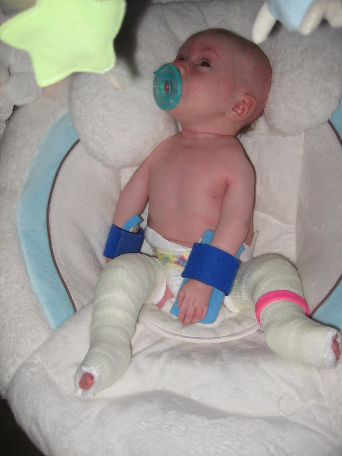 Sweet Analise Rose's Journey with Arthrogryposis, Amyoplasia type ...