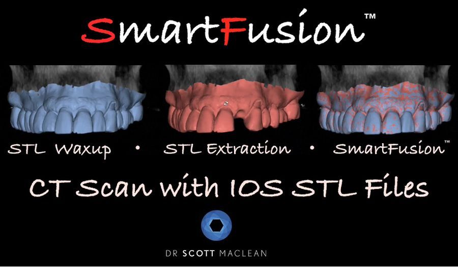 IMPLANTOLOGY: Intraoral scan for implant planning - Odonto-Tv