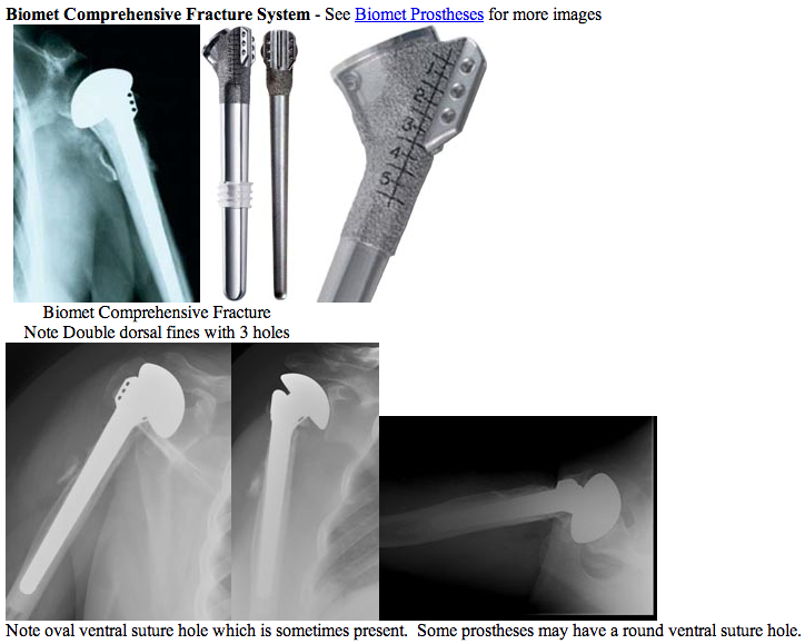 Shoulder and Elbow Surgery: Identifying the implanted shoulder ...