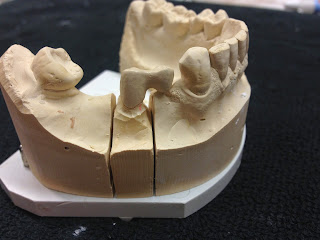 Zahnmedizin und Technik: Die Zirkon Krone oder VMK Krone