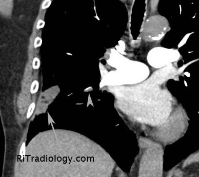 RiT radiology: Pulmonary Infarction