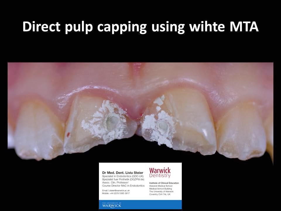 Implantdentistry and related topics: Direct pulp capping in a dental ...