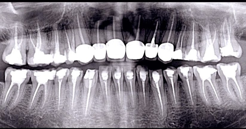 ENDODONTICS: How many x-rays needed during root canal therapy? - Odonto-Tv