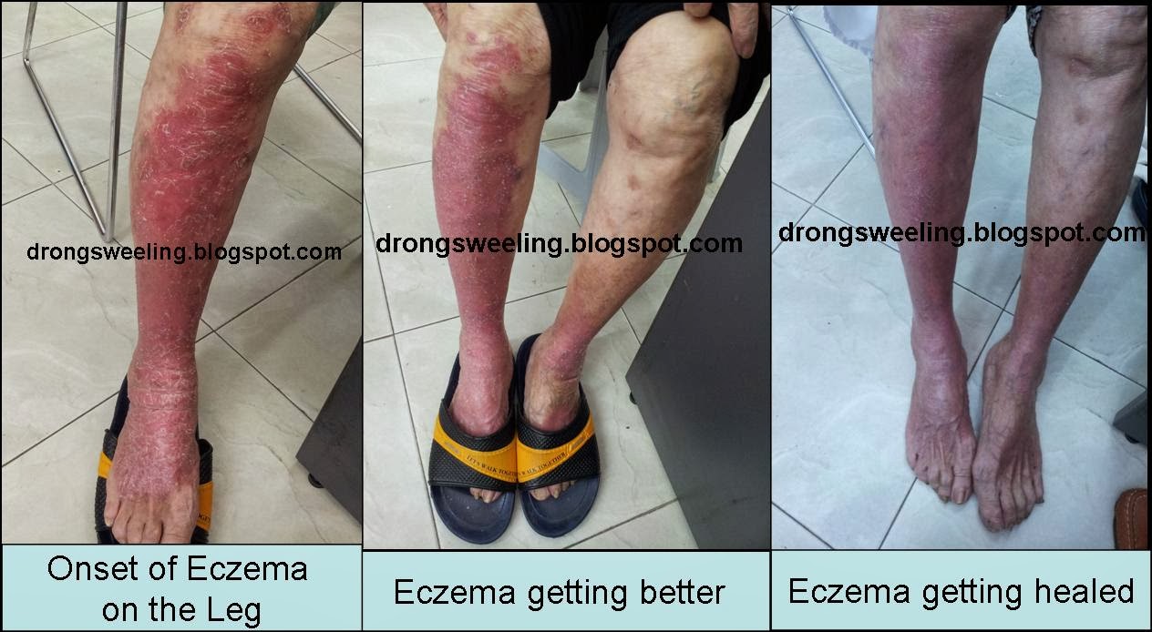 TCM News: Best TCM Dermatologist Singapore for Eczema & Psoriasis