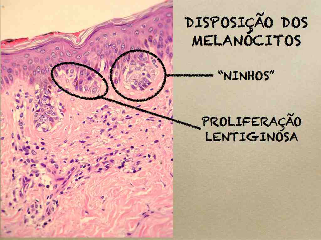 Nevo Melanocítico Composto Displásico - RETOEDU