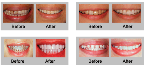 FAMILY CARE DENTAL: DENTAL VENEER