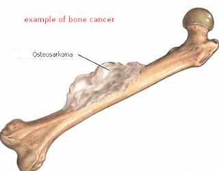 What is bone cancer treatments