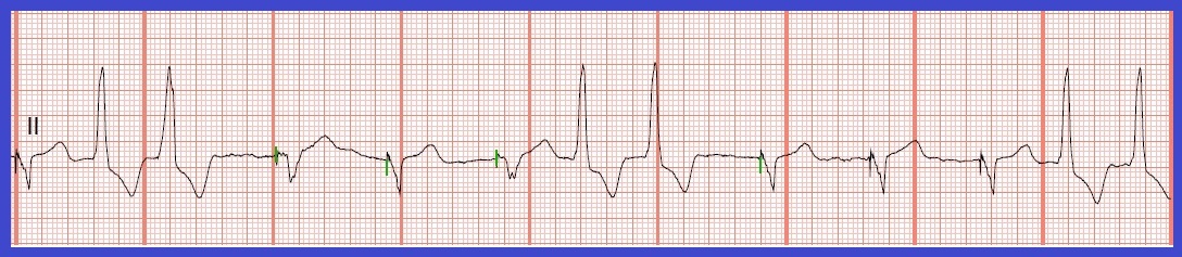 Practice EKG Rhythm Strips 197