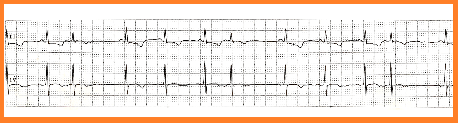 Practice EKG Strips 387