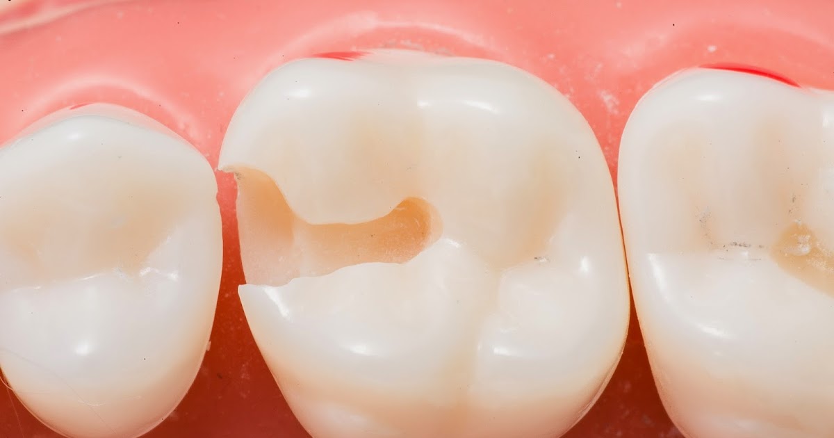 Operative Practical: 14 MO Prep and 12 MOD Composite Fill