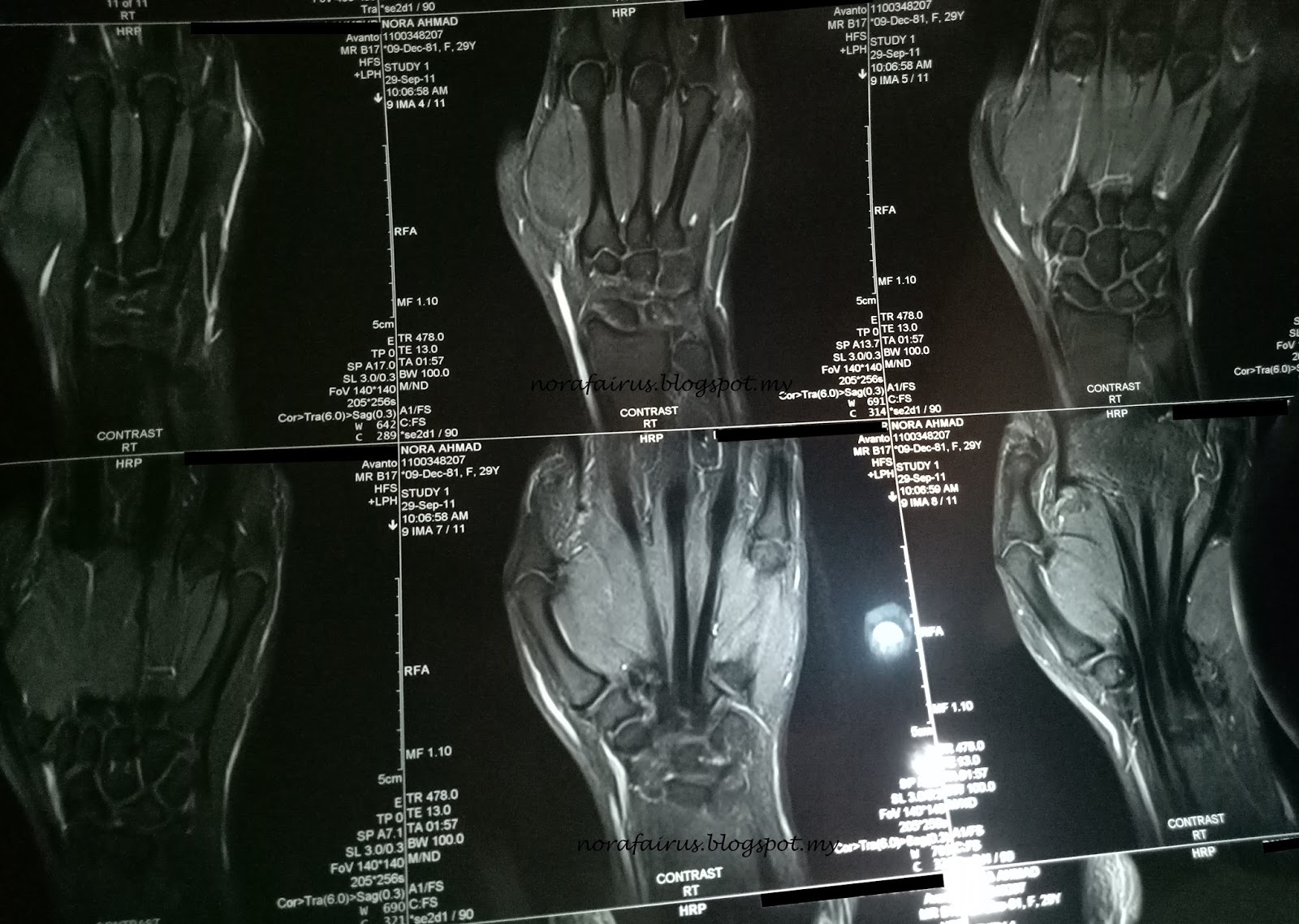 Body & Health Discovery: Carpal Tunnel Syndrome (CTS) | Pengalaman ...