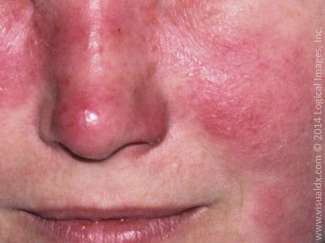 SM Skin Expert: Erythema Nodosum