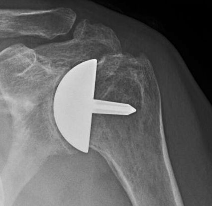 UW Shoulder and Elbow Academy: Failed resurfacing revised to an ...