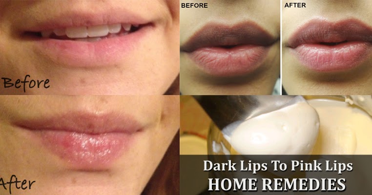 Dark Lips To Pink Lips Naturally - How To Get Pink Lips With This Home ...