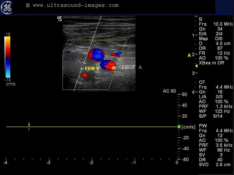 cochinblogs: Severe DVT of the lower limb