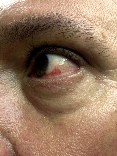 The danger thing for people of subconjunctival hematoma - nyforall