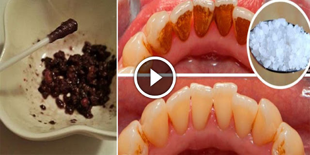 This Can Even Whiten Extremely Yellow Teeth And Remove That Nasty ...