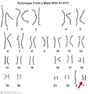 Rock your chromosome: Jacob's Syndrome