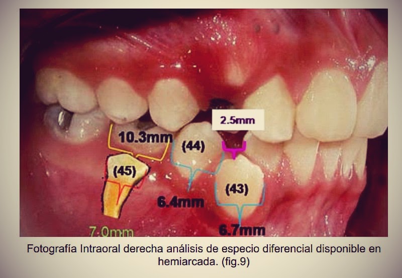 DENTICIÓN MIXTA - Manejo de espacio de Leeway - Ovi Dental