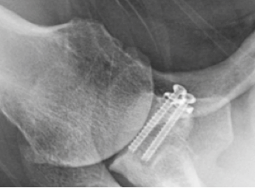 Shoulder Arthritis/Joint Replacement Rotator cuff tears: The Latarjet ...