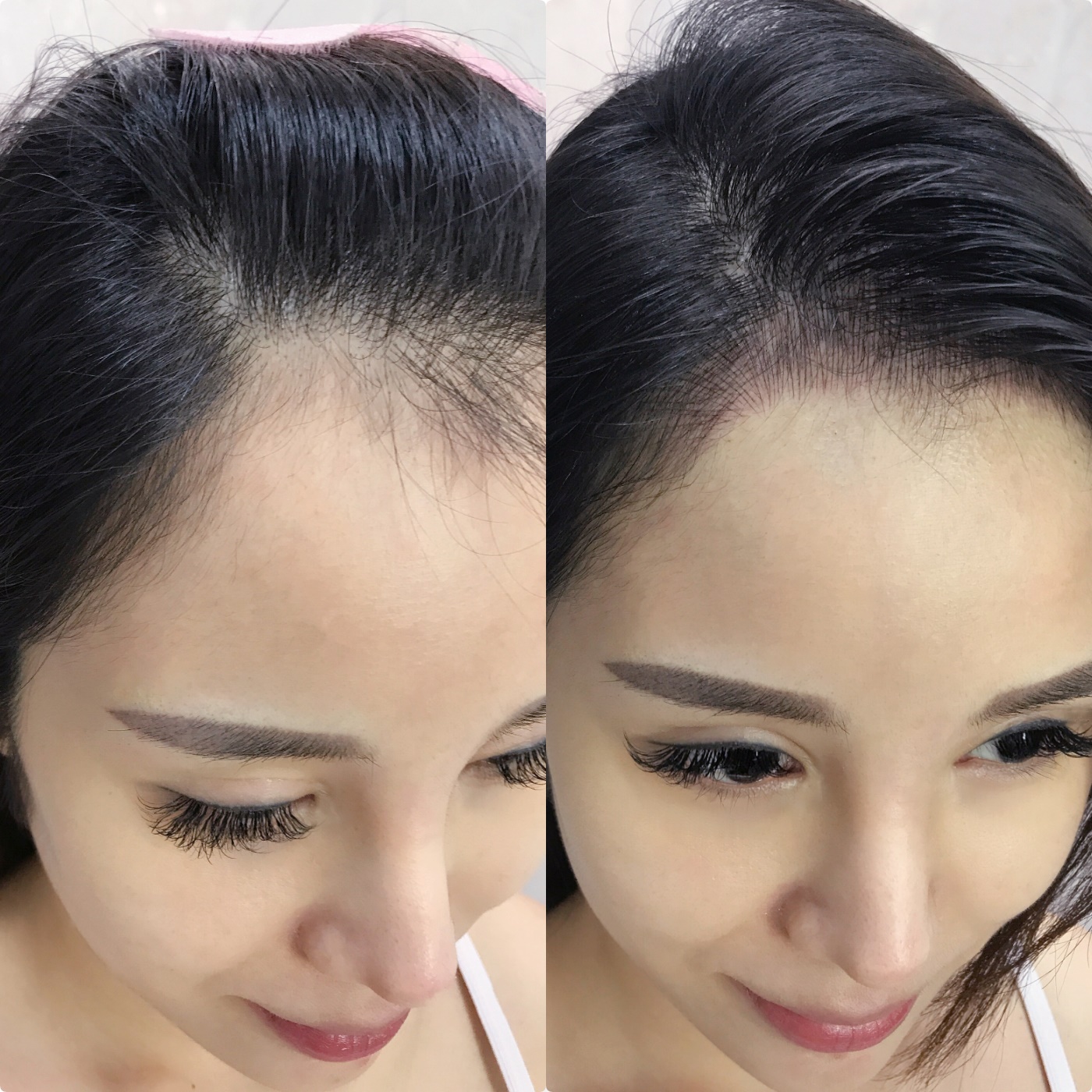 Hairline Microblading – Embrace Beauty