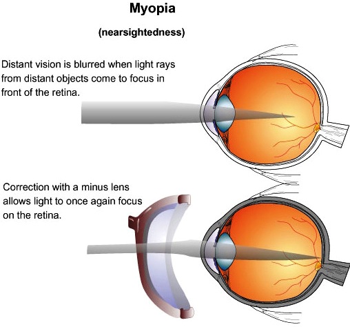 Ainun Theraphy PRI - Terapi Mata Eye Therapy: Rabun Mata