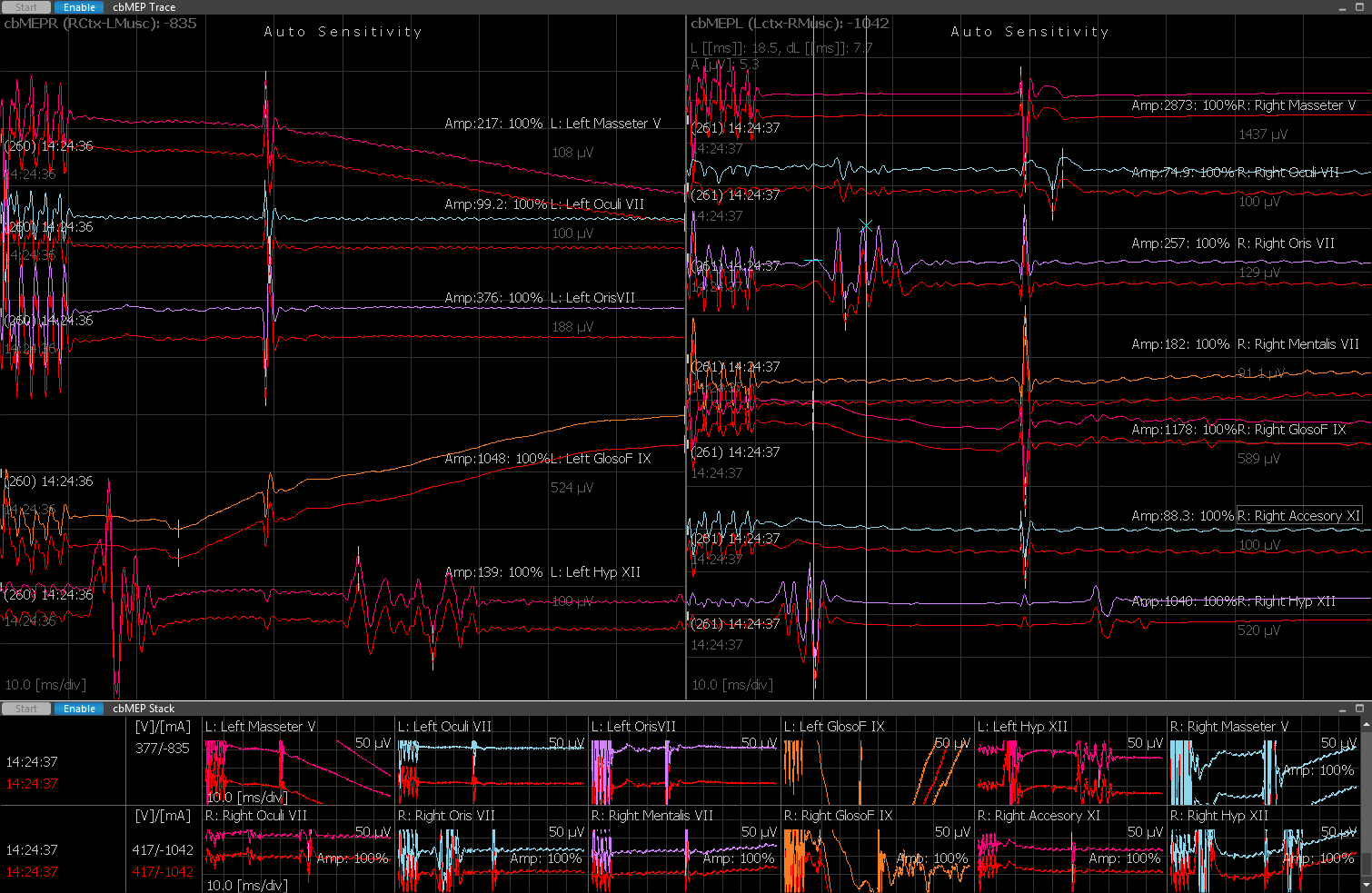 Neurophysiology Plus Iceland: Cerebellopontine angle (CPA) mass IONM