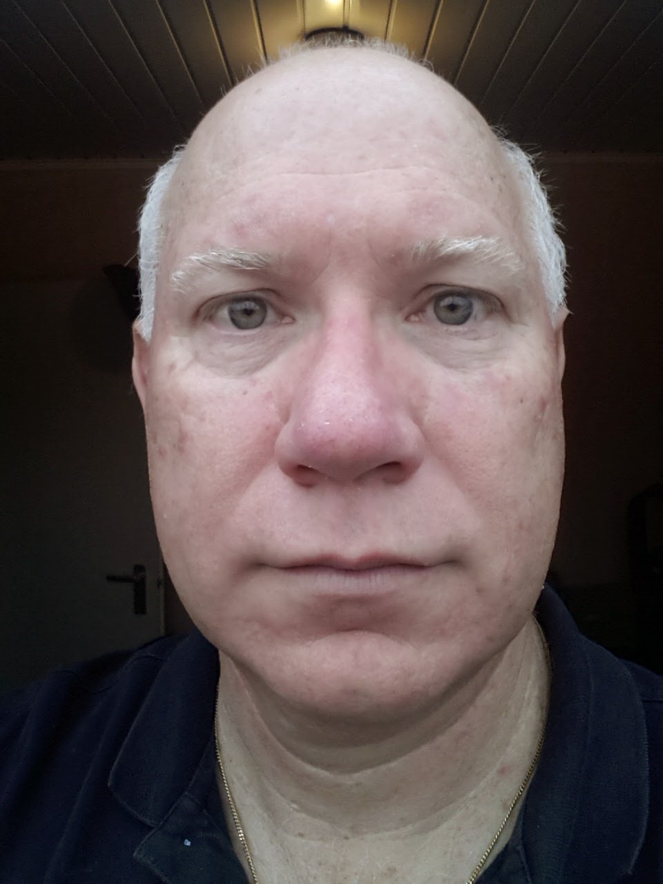 Resultaat gebruik Efudix: Dag 01