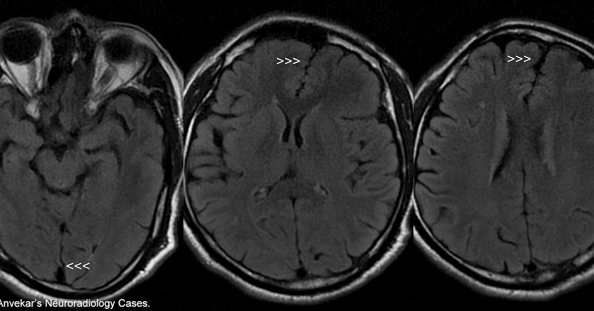 Neuroradiology Cases: Asymmetry of Cerebral Hemispheres